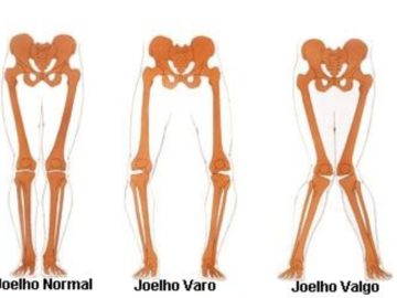 Joelho Valgo: Como Tratar E Como Prevenir Problemas? - Instituto Trata