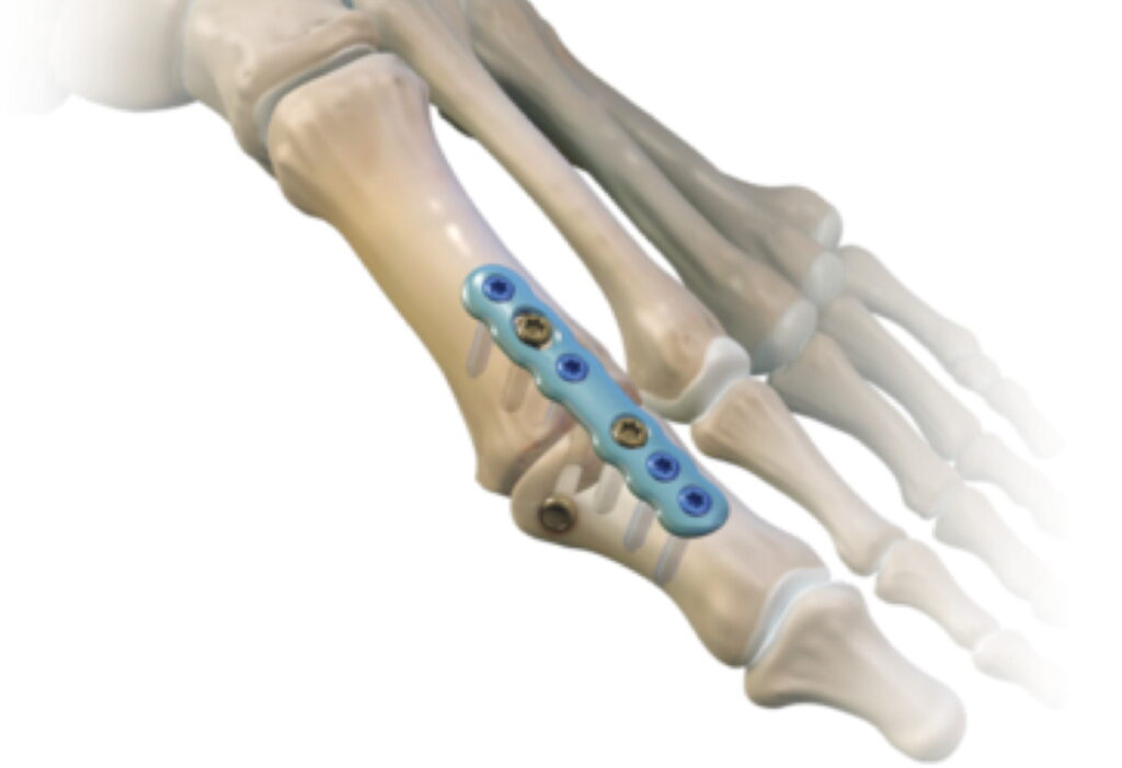 Hallux Rígidus: tratamento, cirurgia e sintomas - Instituto Trata